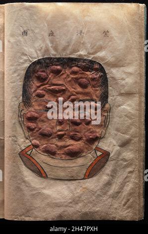 Smallpox, textured illustration, Japanese manuscript, c. 1720 Stock ...