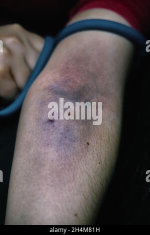 Bruise on a woman's arm, hematoma symptom of fragile capillaries and ...