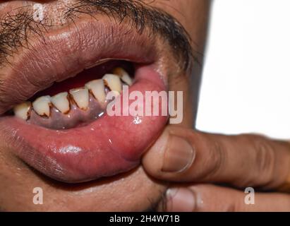 Abscess or cyst with pus at lower lip of Asian man Stock Photo - Alamy