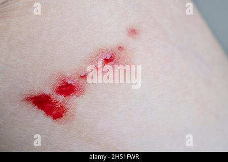 closeup bleeding scar on caucasians skin because of cat scratching ...
