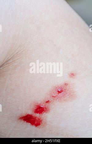 closeup bleeding scar on caucasians skin because of cat scratching ...