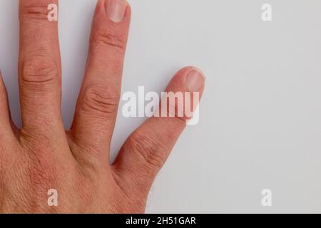 Adult male hand showing distortion and deformity of little finger due ...
