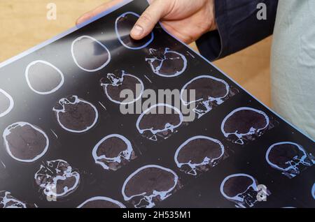 A CT scan of the brain of a patient with traffic accident showing acute ...