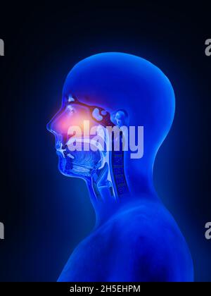 Allergic Sinusitis illness as a nasal cavity blockage disease with a ...