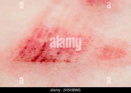 Scratch on human skin close up. Long cut on human skin Stock Photo - Alamy