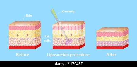Mechanism of liposuction. Suction-assisted liposuction. Hollow tube or ...