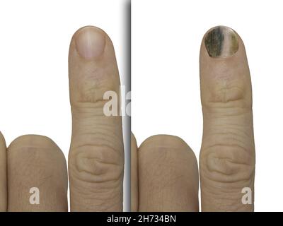 Fungal infection (tinea). Fingernail damaged by a fungal infection ...