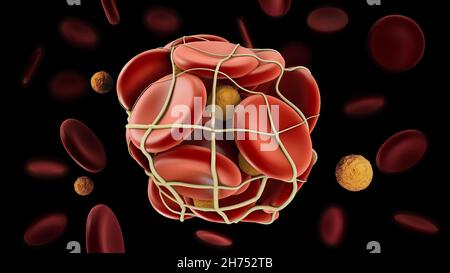 PULMONARY EMBOLISM, DRAWING Stock Photo - Alamy