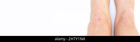 Knee joint effusion ( water on the knee).Acute psoriatic arthritis ...