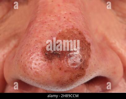 Dubreuilh melanoma Stock Photo - Alamy