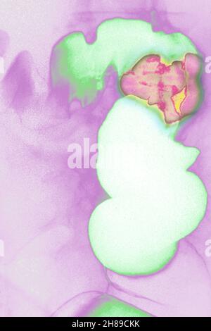 Colon cancer. Barium enema X-ray of the abdomen of a patient with ...