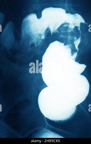 Colon cancer. X-ray of the large intestine of a patient with cancer of ...
