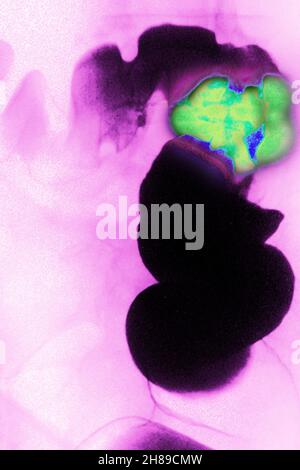 Colon cancer. Barium enema X-ray of the abdomen of a patient with ...