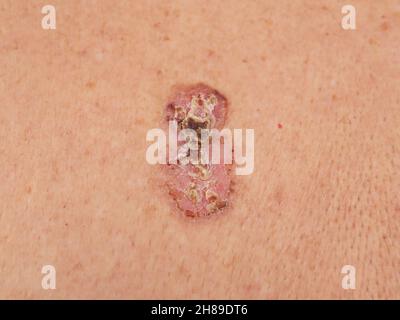 Skin cancer. Nodular basal cell carcinoma on a 75-year-old man's temple ...
