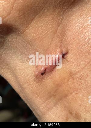 Basal cell carcinoma excision Stock Photo - Alamy