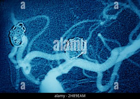 Embolization of cerebral aneurysms Stock Photo - Alamy