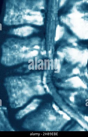 Slipped disc. Magnetic resonance imaging scan of a sagittal section ...