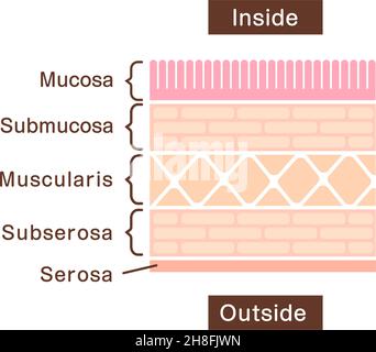 Peptic ulcer disease. Stomach wall with a sore on the lining. Digestive ...