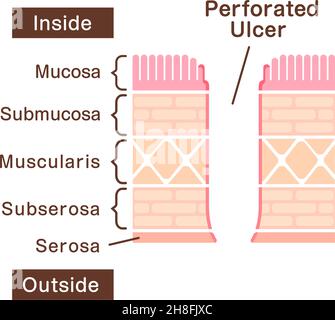 Sectional view illustration of perforated ulcer Stock Vector Image ...