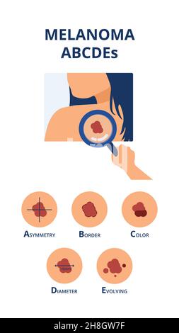 Melanoma diagnosis skin cancer prevention vector illustration Stock ...