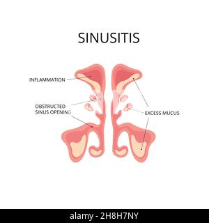 Nasal diseases. Sinusitis, sinus infection diagnosis and treatment ...
