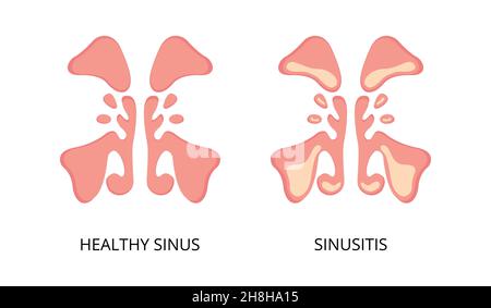 Nasal diseases. Sinusitis, sinus infection diagnosis and treatment ...