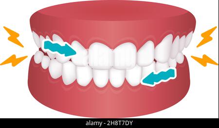 Bruxism vector illustration | tapping teeth Stock Vector Image & Art ...