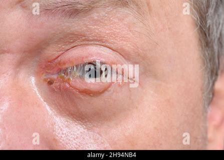 Viral conjunctivitis. Close-up of the bloodshot eye of an 80 year old ...