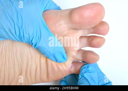 The human feet is a fungal skin lesions isolated on white background ...