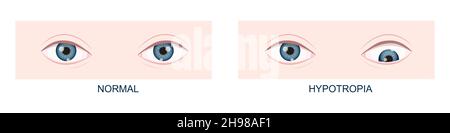 Human eye anatomy infographic. Human Eye Extraocular Muscles. Structure ...
