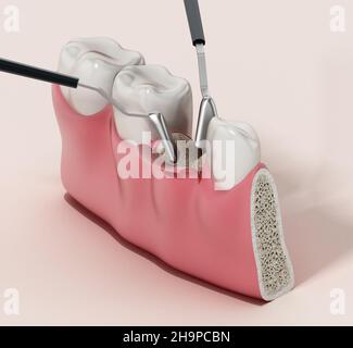 3D illustration of mid-crestal incision dental operation. 3D ...