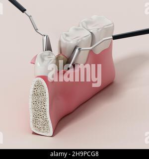 3D illustration of mid-crestal incision dental operation. 3D ...