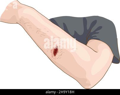 vector illustration of sewing up the wound with surgical needle Stock ...