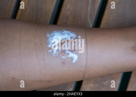 Skin burn on the leg of a young woman, close up. Injury was caused ...