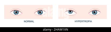Type of strabismus vector illustration / Hypertropia Stock Vector Image ...