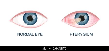 Pterygium eye disease vector illustration Stock Vector Image & Art - Alamy