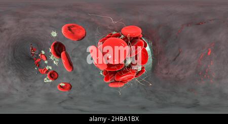 Blood clot made of red blood cells, platelets and fibrin protein ...