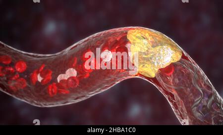 Atherosclerosis. Illustration showing fatty plaque (atheroma, yellow ...