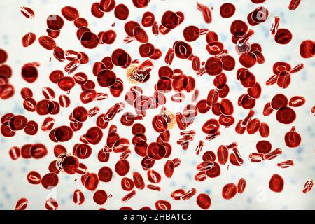 Illustration of polycythemia vera, a rare blood cancer with an increase ...