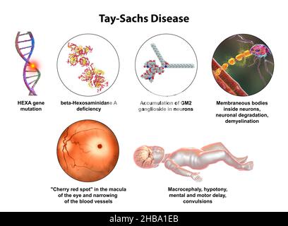 Illustration of Tay-Sachs disease, a genetic disorder that ...