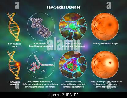 Illustration of Tay-Sachs disease, a genetic disorder that ...