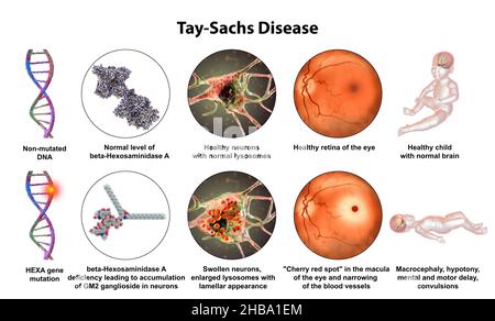 Illustration of Tay-Sachs disease, a genetic disorder that ...