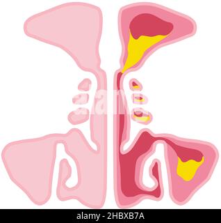 Illustration showing healthy sinus and sinusitis with inflamed lining ...
