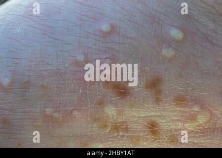 hand closeup skin disease psoriasis Stock Photo - Alamy