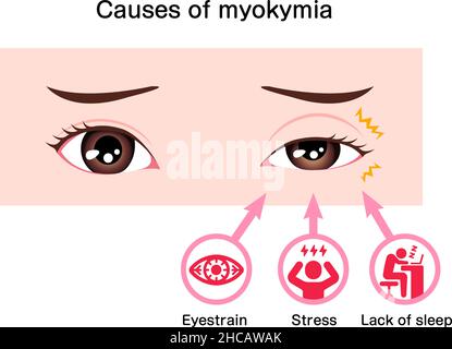 Causes of myokymia (eyelid twitch or tic) vector illustration Stock ...