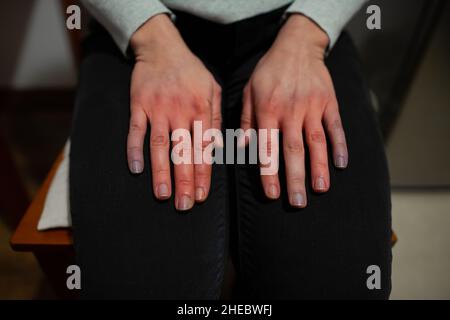 Hands of person with Raynaud's phenomenon during attack with some ...