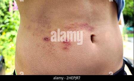 shingles rash on the belly Stock Photo - Alamy