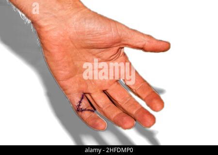 little finger stitched after an operation Stock Photo - Alamy
