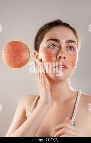 Cosmetology and rosacea. The young woman runs her hands over her ...