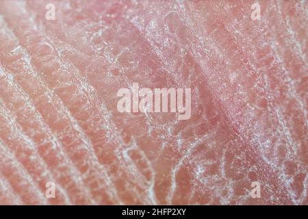 Skin close up. Dry human skin under microscope with eczema damage ...